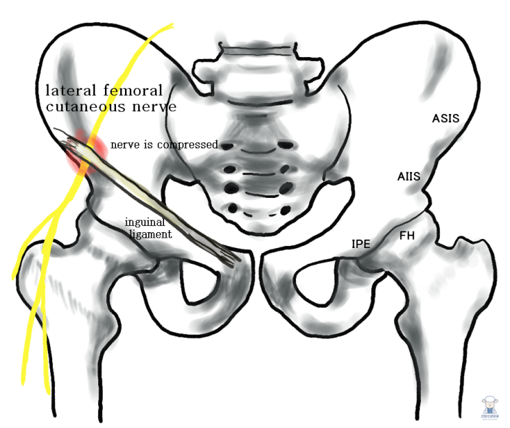대퇴외측피신경 LFCN 지각이상성 대퇴신경통 허벅지 바깥쪽 통증 감각이상 주사 및 신경도수치료 : 네이버 블로그