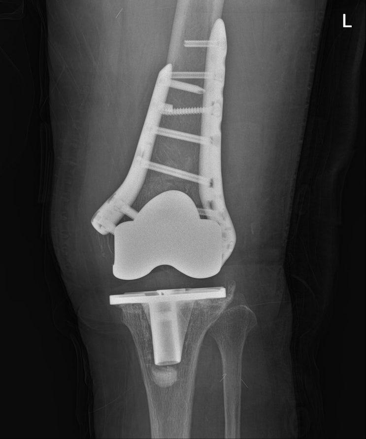 무릎 인공관절 주변 골절periprosthetic Fracture에서 시행한 관혈적 정복 및 내고정술 올바른서울병원