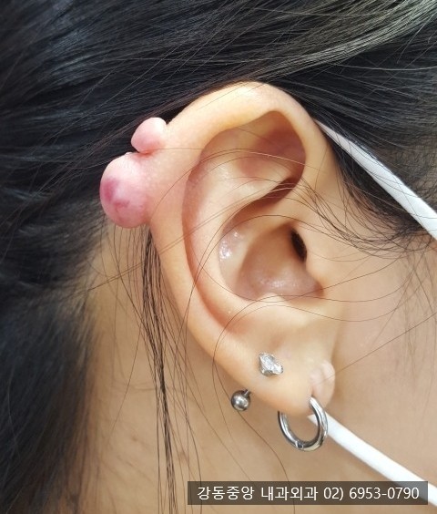 귀바퀴 켈로이드 제거 수술 helix advanced flap 이란? (천보성 외과) : 네이버 블로그