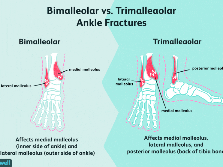 Bimalleolar ORIF (AO) : 네이버 블로그