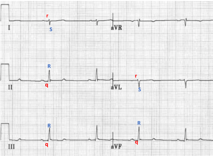 심전도 공부 - Left posterior fascicular block (LPFB) : 네이버 블로그