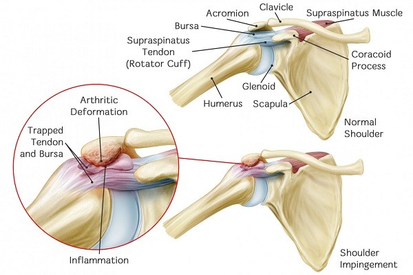 정형외과 :: 어깨충돌증후군 _ shoulder impingement syndrome : 네이버 블로그