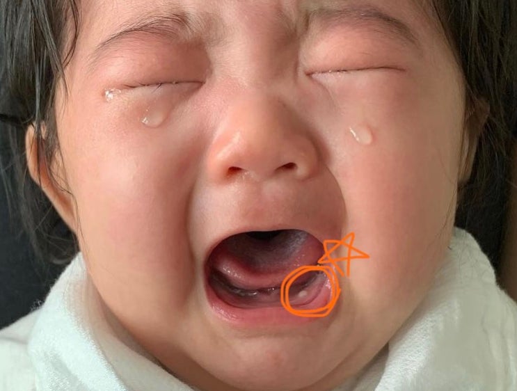 치위생사 엄마가 알려주는 신생아 진주종(epstein pearls) : 네이버 블로그