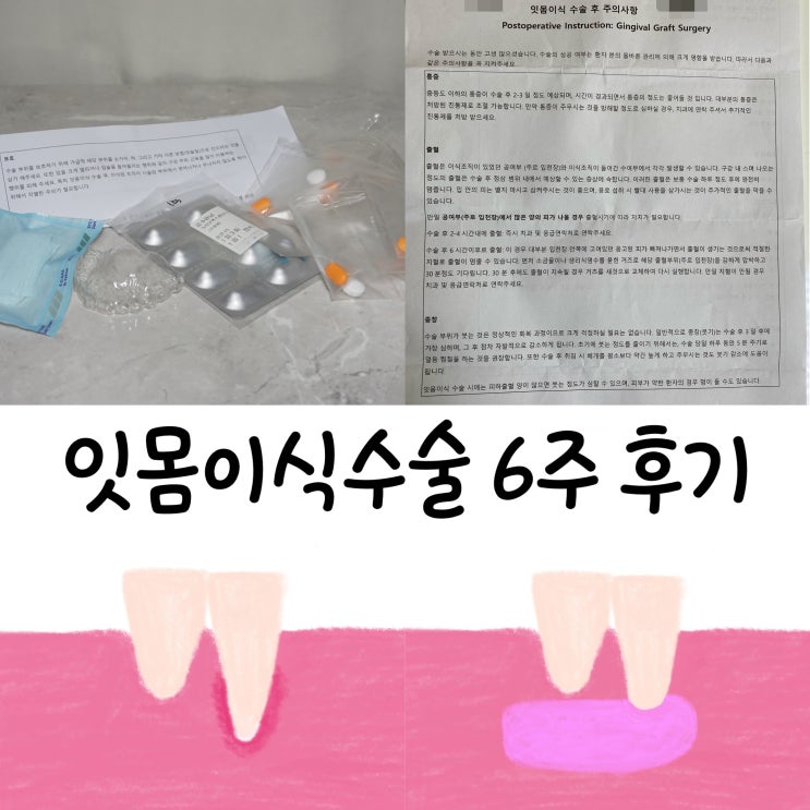 🦷잇몸이식수술 소대절제술 잇몸 퇴축 후기 2 2주 차~6주 차 유리치은이식술 치아교정 부작용 네이버 블로그
