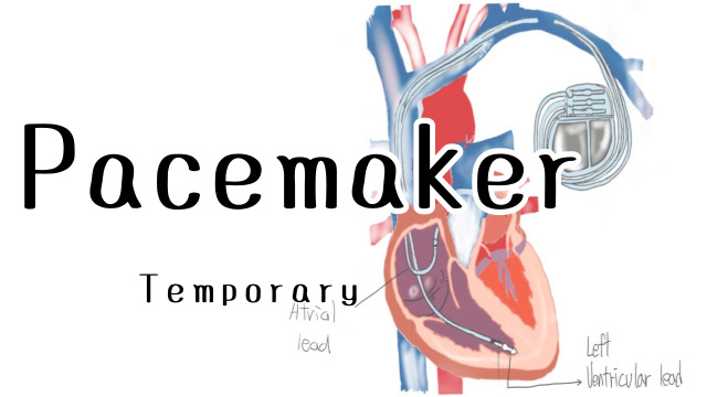 Temporary Pacemaker, 임시형 심박동기 간략 정리 : 네이버 블로그