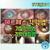 Eye잘보여 헤르페스각막염단순포진각막염 3 재발성 Hsv 눈감염 기질각막염 각막내피염 홍채섬모체염 진단