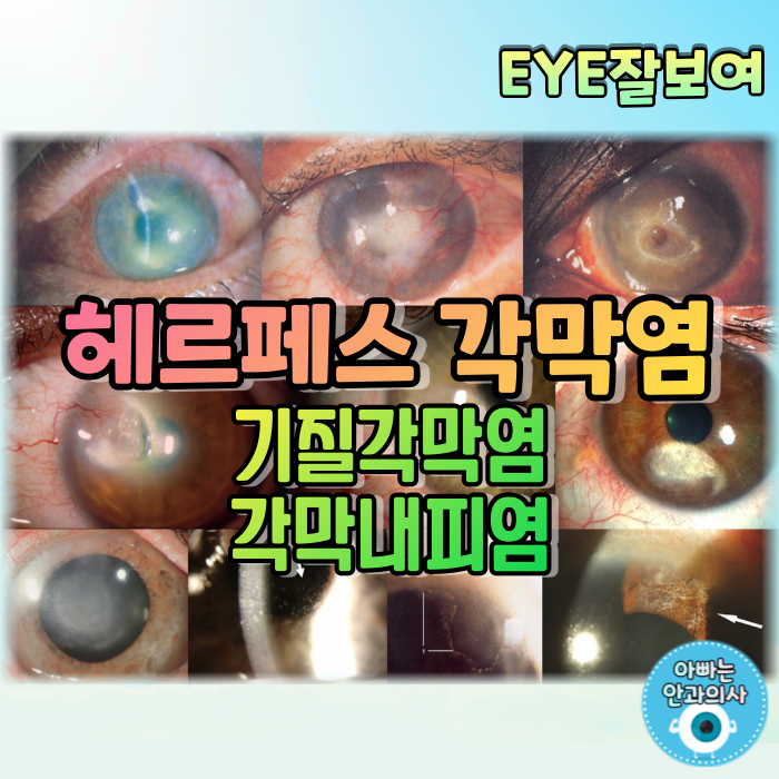 Eye잘보여 헤르페스각막염단순포진각막염 3 재발성 Hsv 눈감염 기질각막염 각막내피염 홍채섬모체염 진단