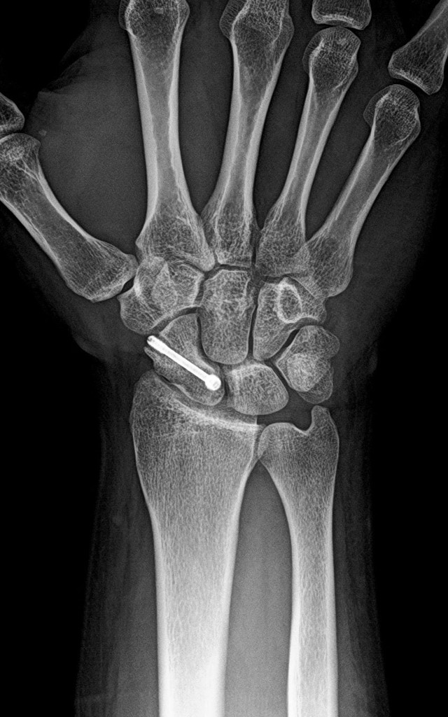 [OS수술] Scaphoid ORIF(Open Reduction Internal Fixation, 개방정복 내부고정) - HCS ...