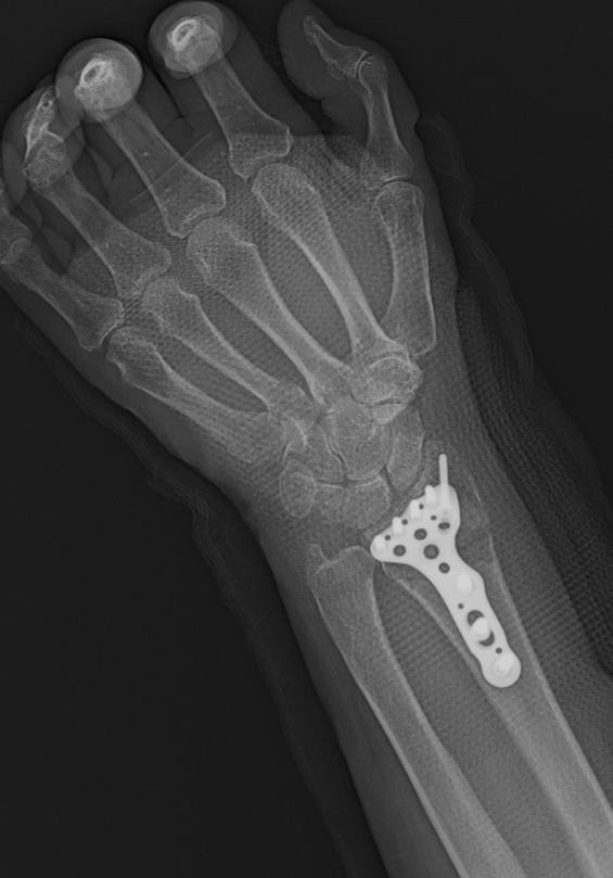 [OS수술] Distal Radius ORIF(Open Reduction Internal Fixation, 개방정복 내부고정 ...