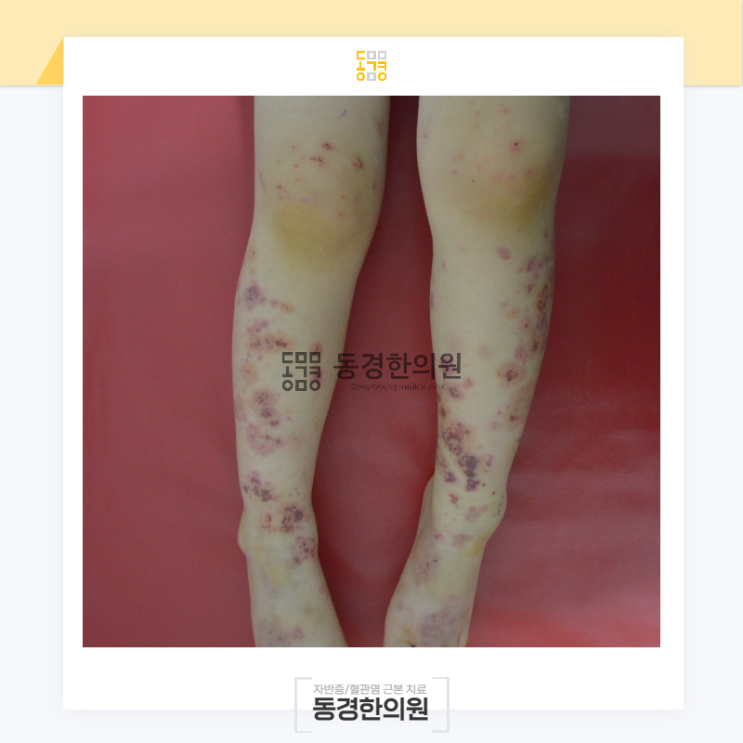 자반증과 신장 치료가 중요한 이유 네이버 블로그
