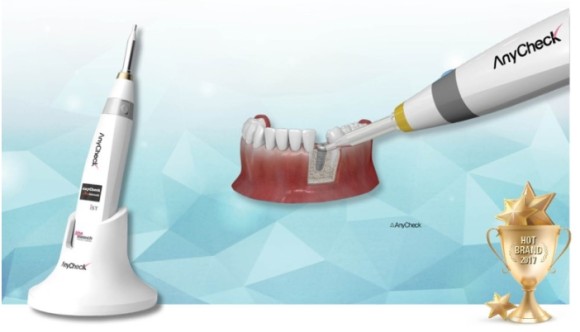 AnyCheck : 임플란트 동요도측정기 (수락산역 연세웰치과 이원재 원장) [수락산역 치과] : 네이버 블로그
