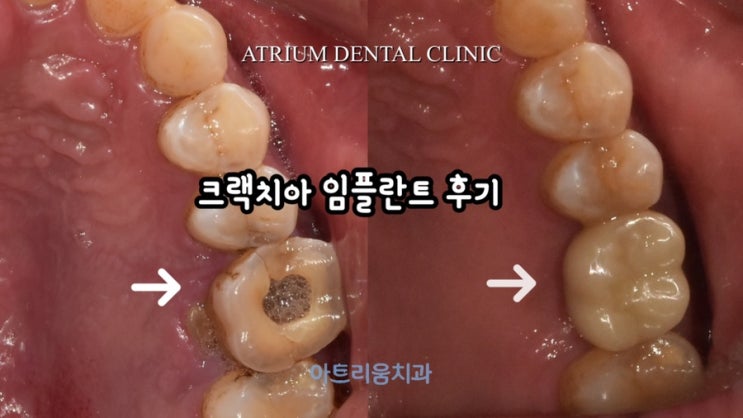 평택치과 크랙 염증치아 임플란트 후기 뼈이식 상악동거상술 네이버 블로그