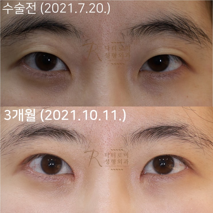 윗눈꺼풀 늘어짐이 심한 눈 절개눈매교정 앞 윗 트임 네이버 블로그