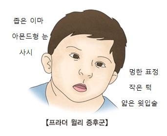 프라더 윌리 증후군 : 네이버 블로그