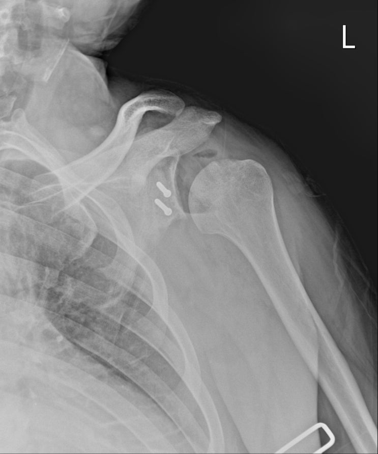 shoulder bankart repair & latarjet procedure : 네이버 블로그