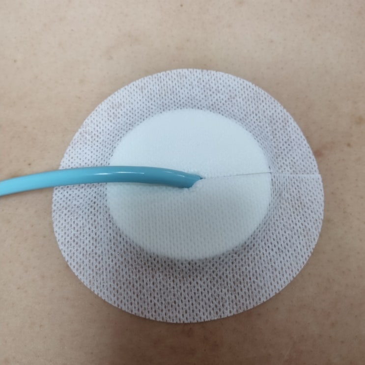 의학용어 suprapubic cystostomy 방광루 설치술에 대해서, 소독은 캐스드레싱 추천 : 네이버 블로그