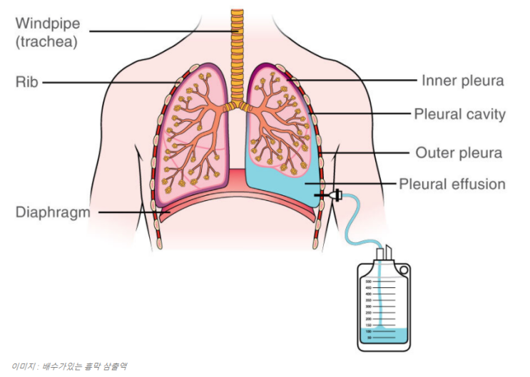 PCD( percutaneous catheter drainage) : 경피적카테터배액술 : 네이버 블로그