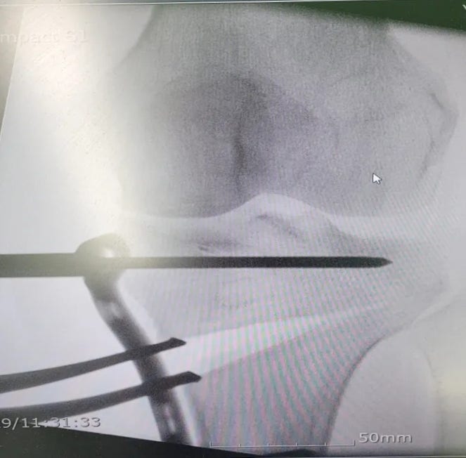 OS) HTO(High Tibia Osteotomy) : 네이버 블로그