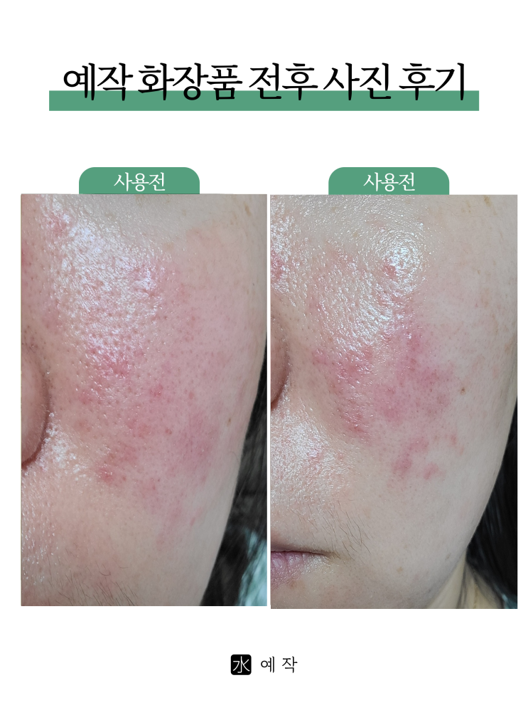 예작화장품 후기 안면홍조 And 트러블 피부 개선 네이버 블로그
