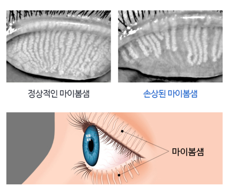 눈찜질팩과 오큐소프트로 안구건조증 완화하기 온찜질 눈꺼풀 세정 마이봄샘 관리 네이버 블로그