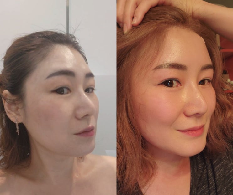 강남 미간 보톡스이마필러 여자남자 이마 잔주름 이마라인 몰딩 직후 통증 부작용 관리 가격 추천 후기 네이버 블로그