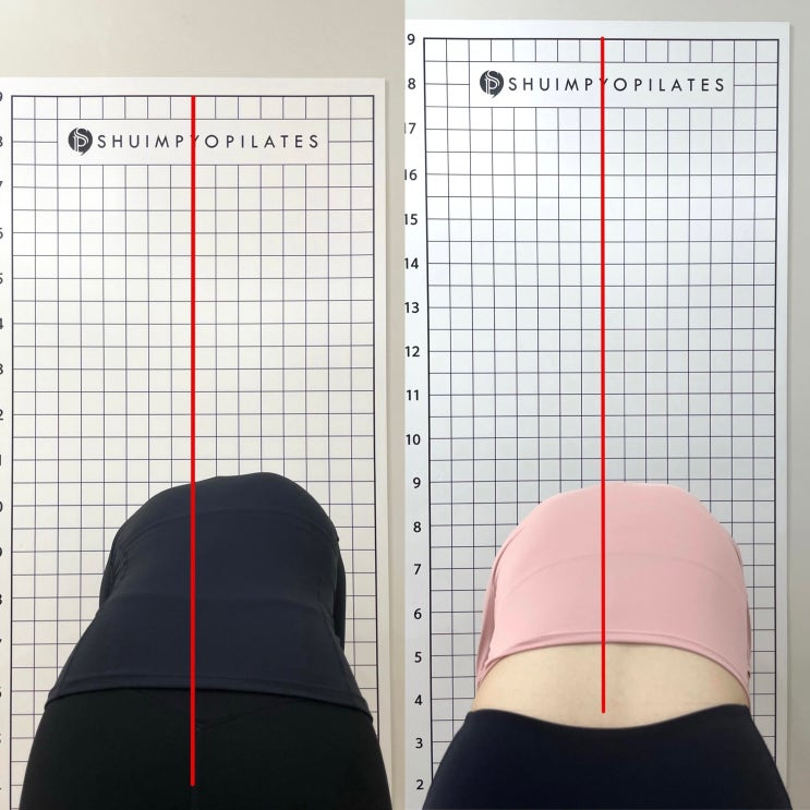 대구 동구필라테스 개인레슨 척추측만 교정 Before → After 비교 네이버 블로그