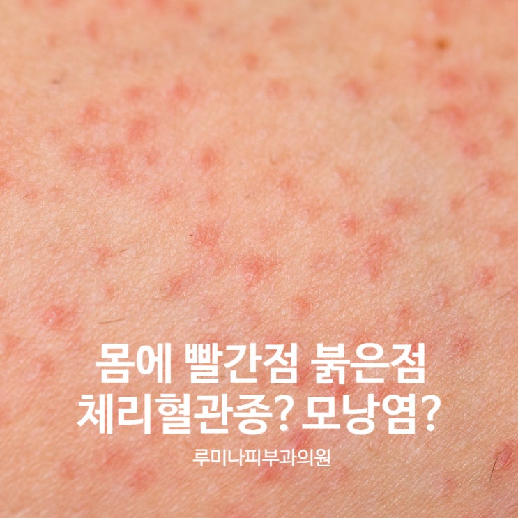 용인 풍덕천동피부과몸에 붉은점 빨간점체리혈관종모낭염 네이버 블로그
