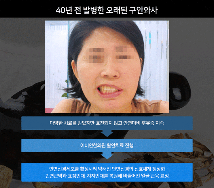 오래된 구안와사안면마비후유증 치료에 왜 도침치료가 필요한가 네이버 블로그
