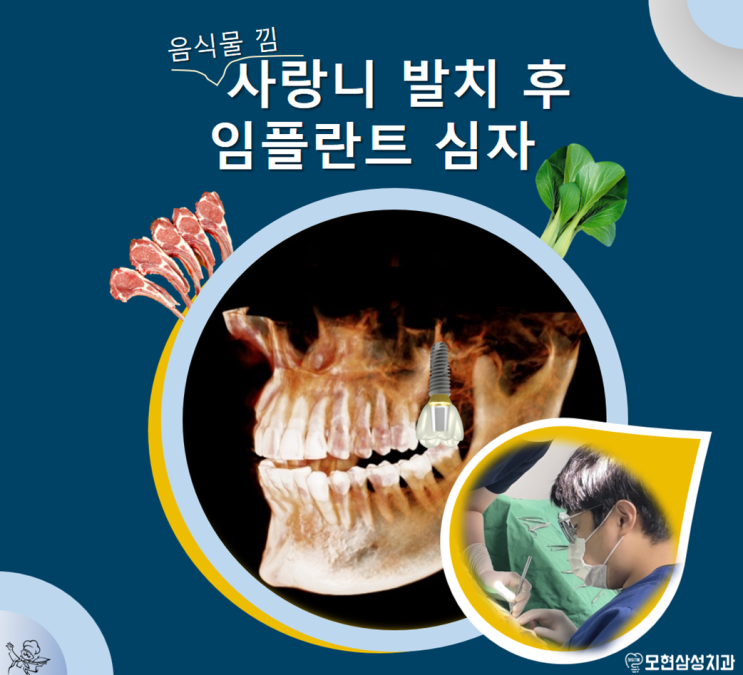 【모현삼성치과】 음식물낌으로 충치가생겼어요사랑니발치후 임플란트 네이버 블로그