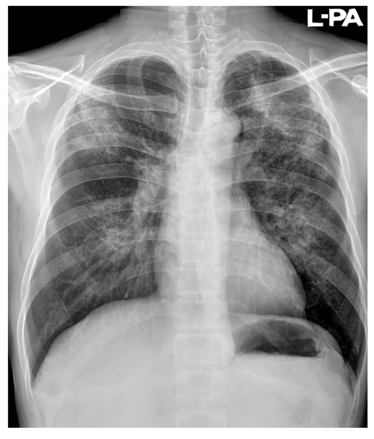 활동성 폐결핵 엑스레이 증례, 폐경화, galaxy sign, 림프절비대, 림프절병증, 공동성 결절 : 네이버 블로그