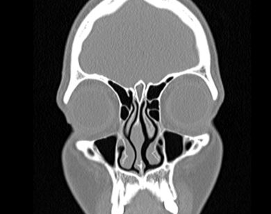 (수술 공부) ENT: Endoscopy sninus surgery, ess:sinusitis,비부비동염수술,축농증 : 네이버 블로그