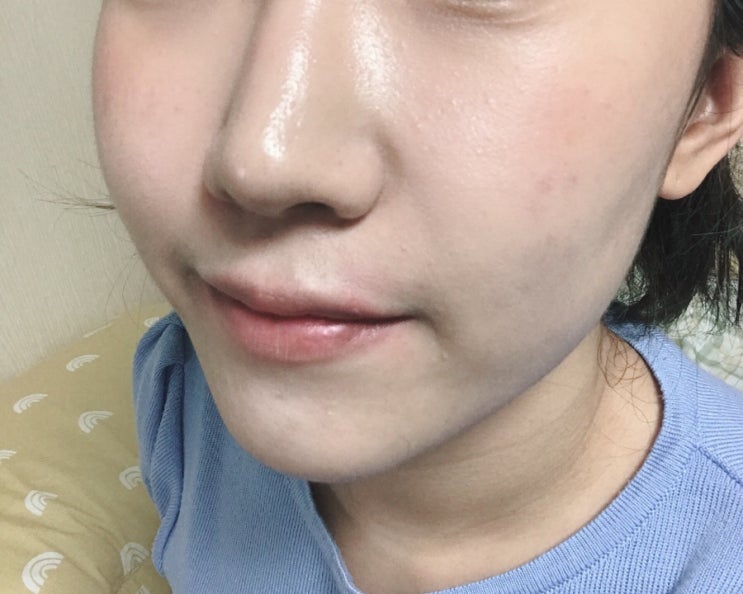 내돈내산 신사역성형외과 스킨부스터 리쥬란힐러 통증 웨딩스냅 촬영전 신부관리 추천 네이버 블로그