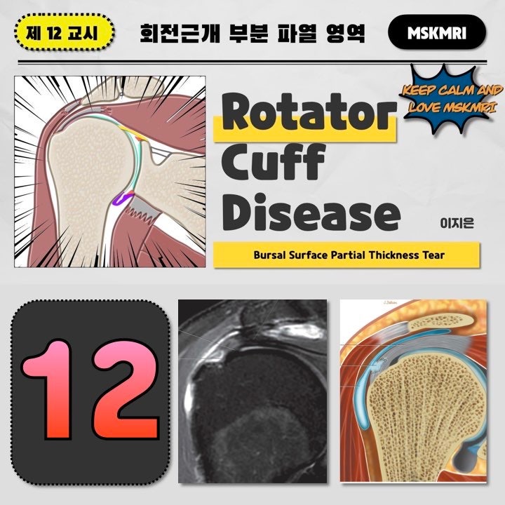 [Rotator cuff Tear 12] Bursal surface Rotator Cuff Partial Tear ...