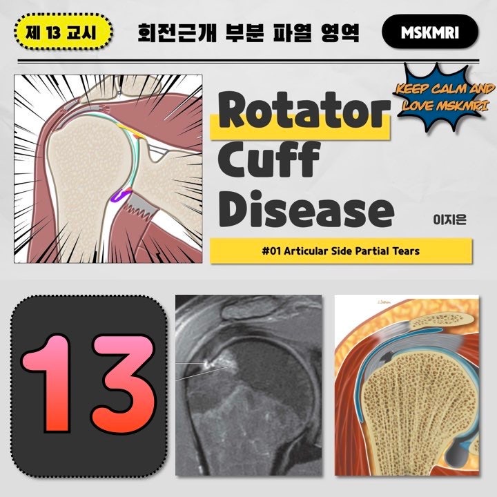 [Rotator cuff Tear 13] #1 Articular Rotator Cuff Partial Tear, PASTA ...
