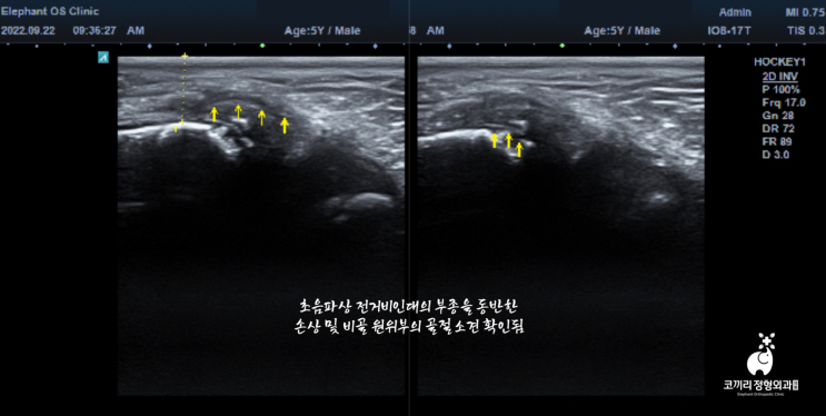 코끼리정형외과 소아 발목 염좌에서 초음파 검사가 중요한 이유 네이버 블로그