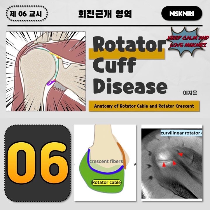 [Rotator cuff Anatomy 06] Anatomy of Rotator Cable and Rotator Crescent ...