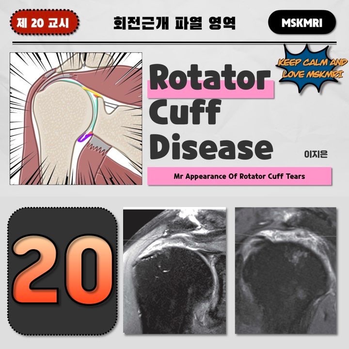 [Rotator cuff Tear 20] MRI findings of Rotator Cuff Tears : 네이버 블로그