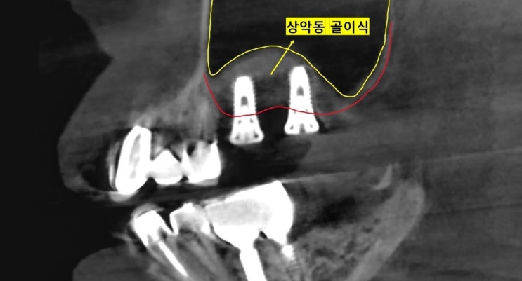 상악동 거상술측방 접근법 상악동 임플란트 Feat 임플란트 수술이 어려운 분들을 위한 방법 네이버 블로그