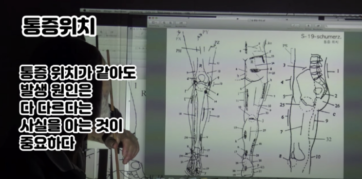 53. 족저근막염과 발바닥 통증 원인과 KSNS 스본 스도 방법 : 네이버 블로그