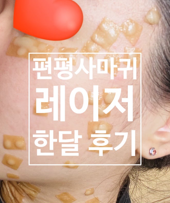 미아 아가파의원에서 편평사마귀 제거하고 1달 후기 : 네이버 블로그