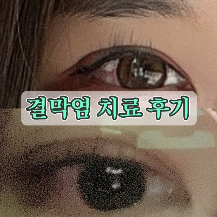 세균성결막염 치료후기 결막염 증상렌즈눈 충혈될때안과 진료비점안액 처방결막염 종류 네이버 블로그