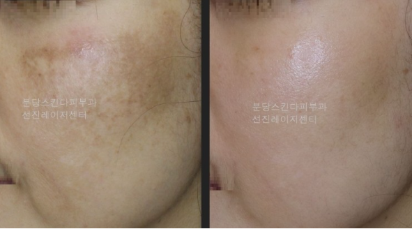 분당피코레이저피코웨이 토닝 기미치료 사례 네이버 블로그