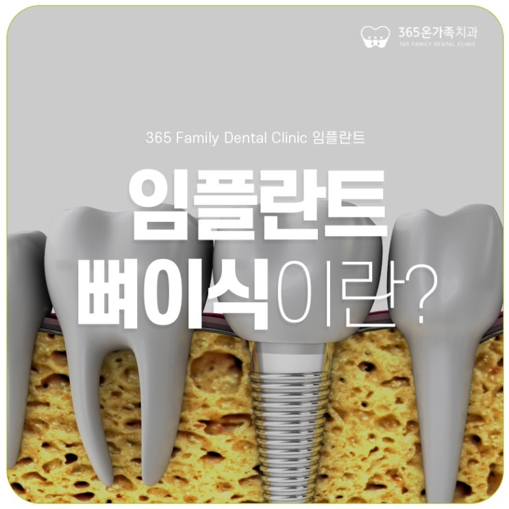봉담치과 단단한 치아를 위한 임플란트 뼈이식이란 네이버 블로그