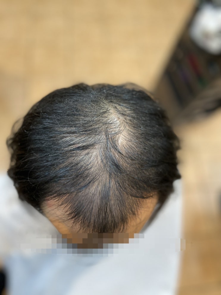 심한남자탈모 부산사상탈모전문 미용실 르네시떼헤어샵에 오시면 탈모펌으로 탈모와 이별준비하셔야됩니다 네이버 블로그
