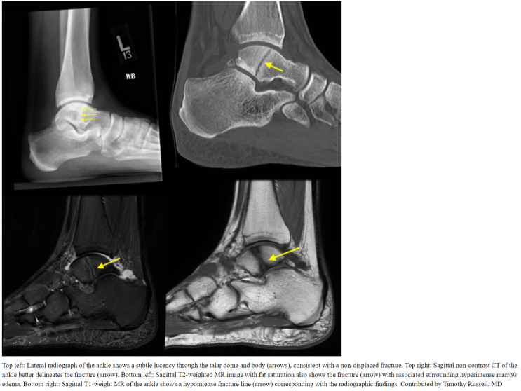 Talus fracture (거골 골절) : 네이버 블로그
