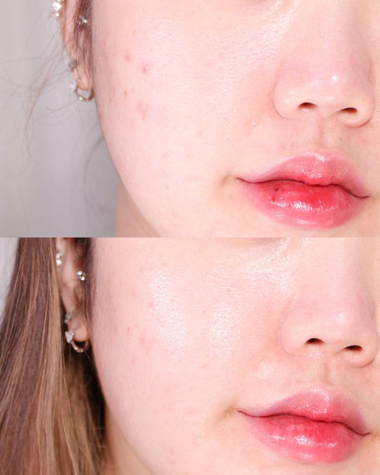 피부장벽크림으로 뒤집어진 내 피부 관리해보기 네이버 블로그