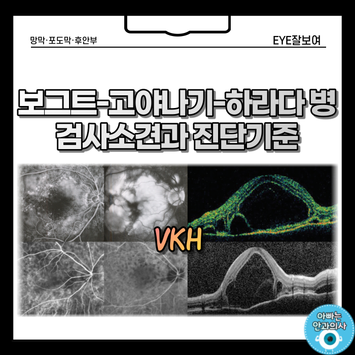 '보그트-고아냐기-하라다 증후군(병), VKH'의 진단 : FAG, ICG, OCT 소견과 진단기준 : 네이버 블로그