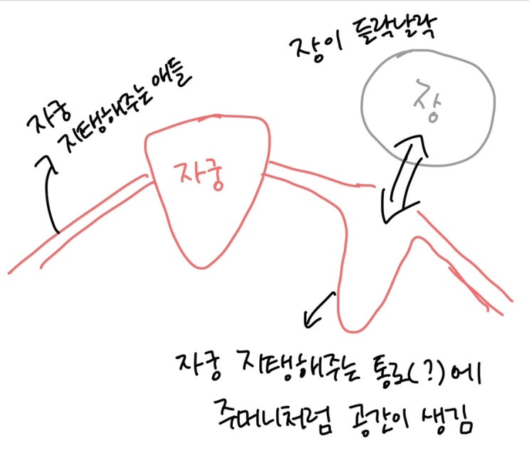 성인 여자 서혜부 탈장 수술 후기 2 입원수술후기 인천국제성모병원 네이버 블로그