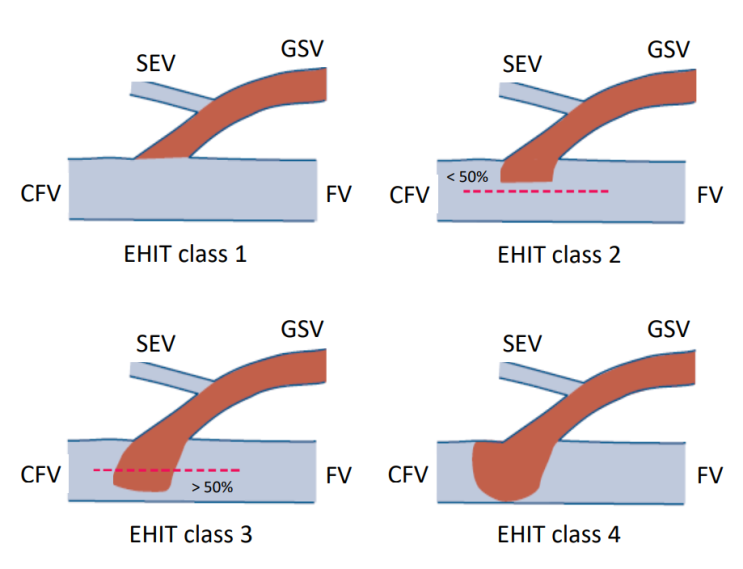 EHIT(Endovenous Heat-Induced Thrombus)의 2021년 version[논문 톺아읽기 1] : 네이버 블로그