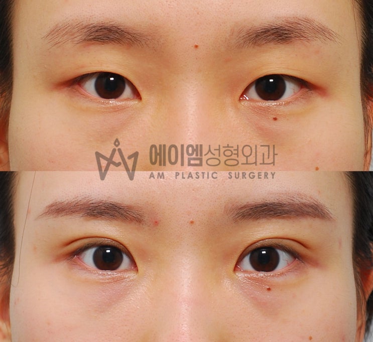 눈 재수술 고찰 108 인아웃라인 쌍수절개붓기 눈처짐수술 쌍꺼풀 눈매교정 네이버 블로그